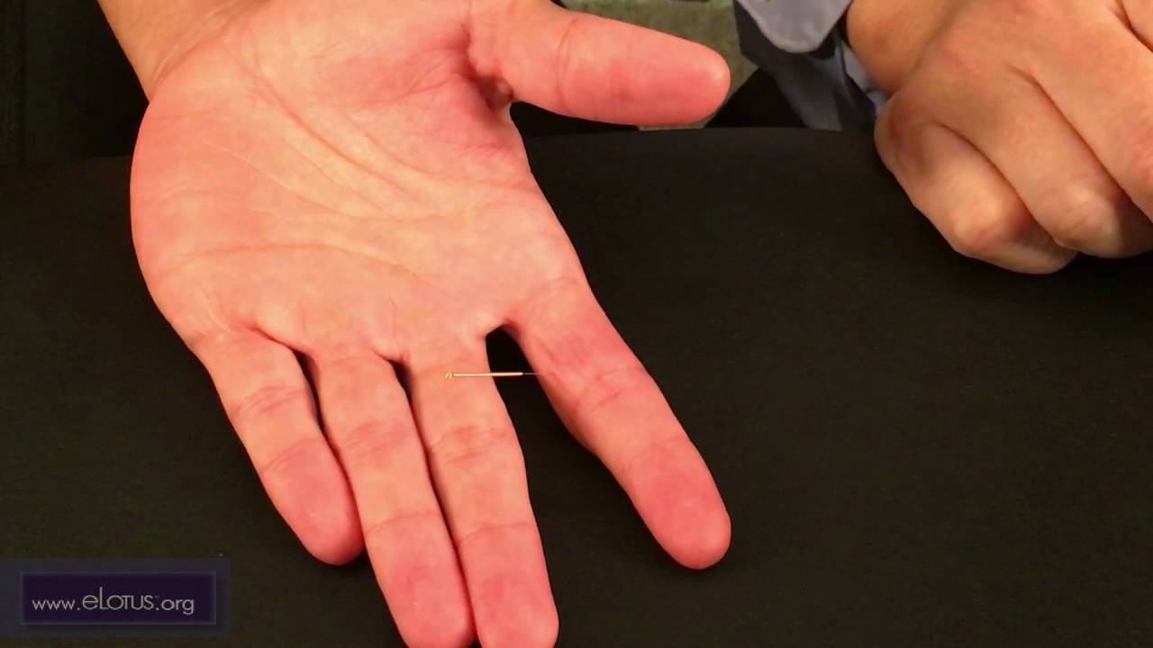 Mu (T 11.17): Master Tung Point Location and Needling Technique in ...