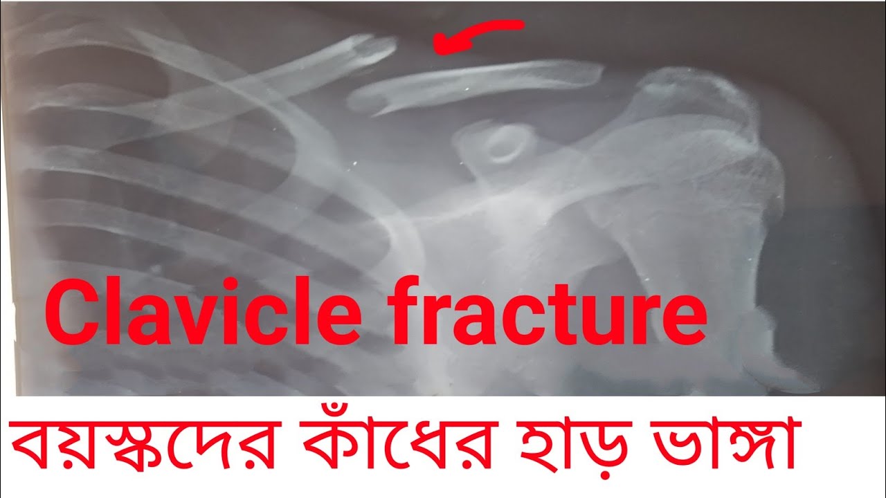Adult Clavicle fracture conservative Treatment and rehabilitation ...