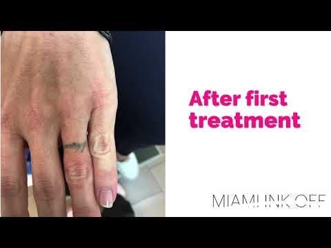 Miami Ink Off tattoo removal
