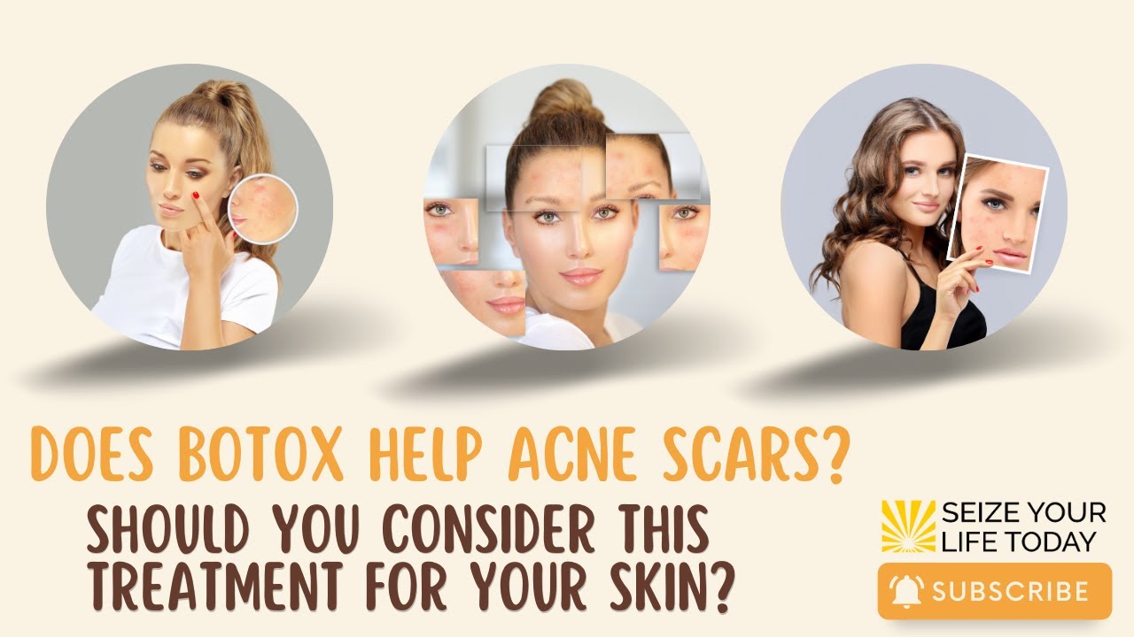 Can Botox Treat Acne Scars? - How long will Botox last? - Are Botox ...