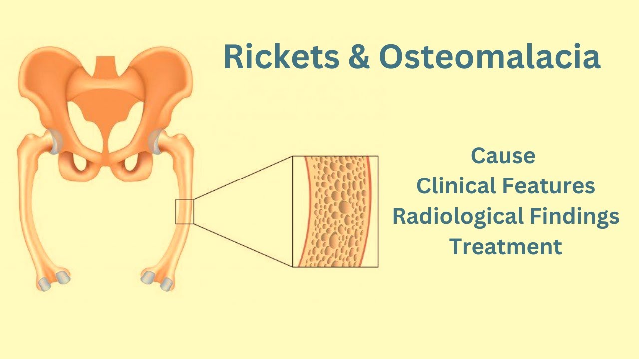 Rickets & Osteomalacia: Causes, Clinical features, Radiological ...