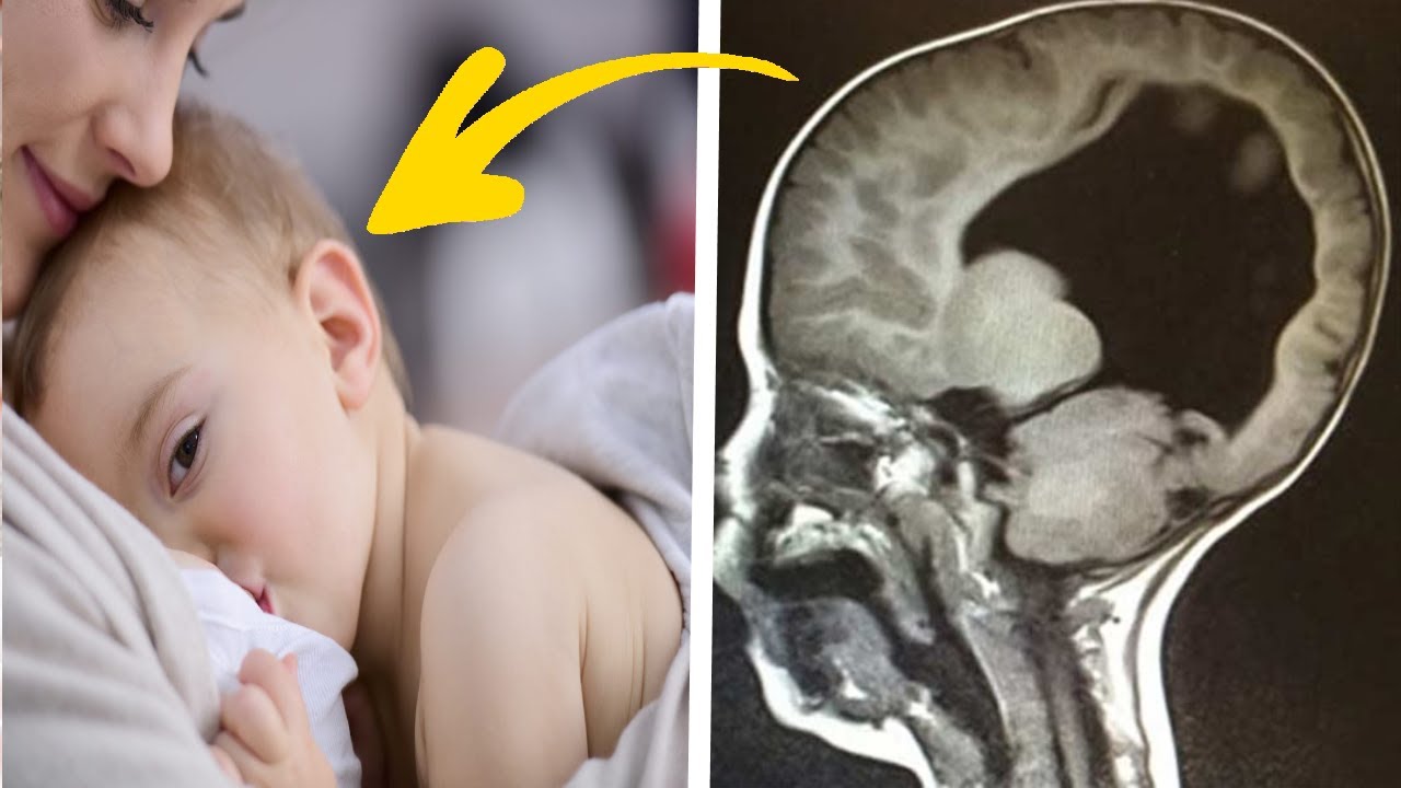 Boy Born Without A Brain, 6 Years Later Look At What Doctors Find ...