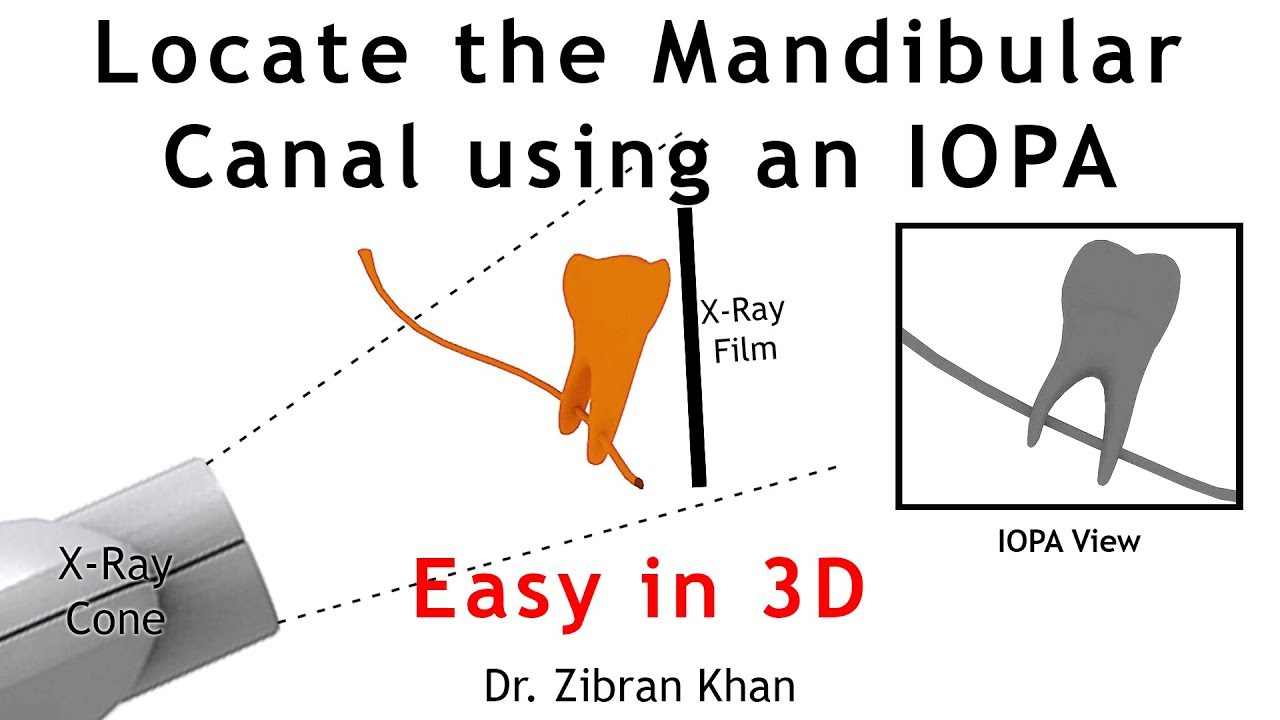 Frank's Tube Shift Technique - Dr. Zibran Khan - YouTube