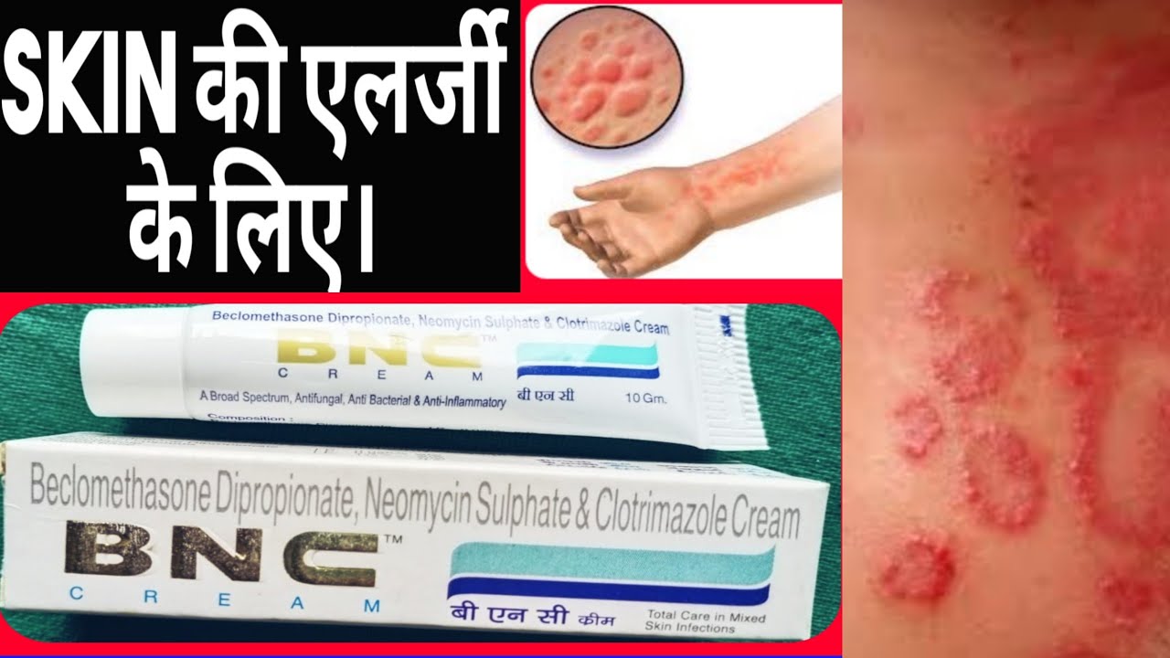 Bnc Cream Uses | Allergy Ki Cream | Bnc Cream Side effects | Bnc Cream Full Review Hindi - YouTube
