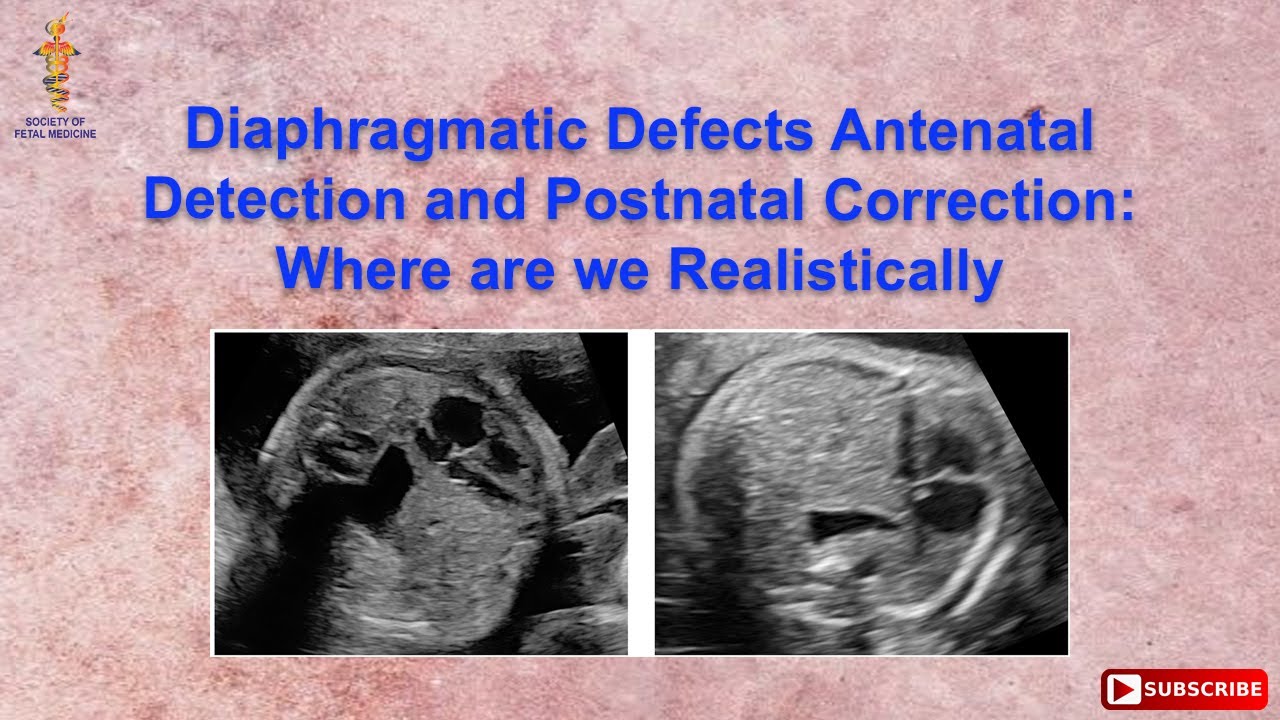 Diaphragmatic Defects Antenatal Detection and Postnatal Correction ...