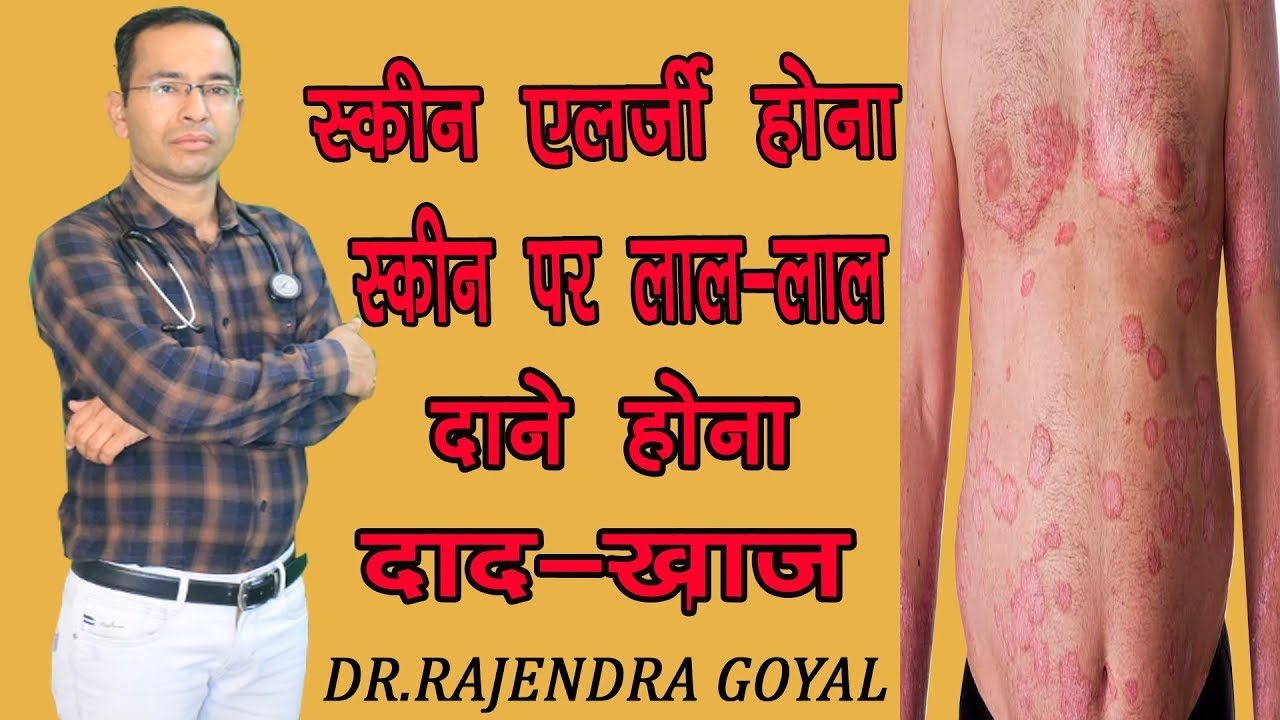 खुजली जड़ से मिटाये और चर्मरोग - स्किन एलर्जी से छुटकारा पाएंSkin ...
