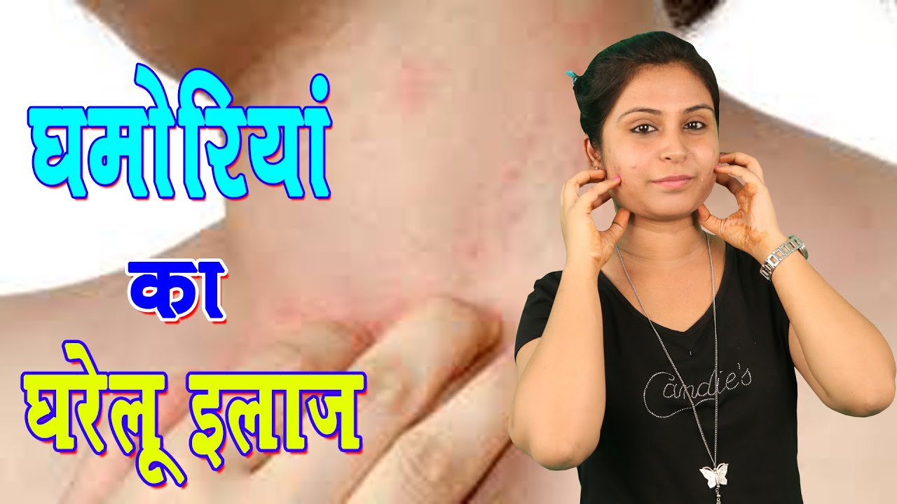 घमोरियां का घरेलू इलाज Home Remedies For Prickly Heat Rashes | Ghamori ...