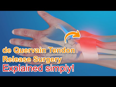 De Quervain Tendon Release Surgery - Explained
