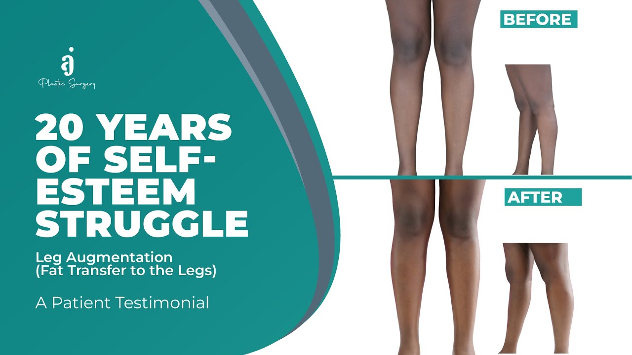 LEG AUGMENTATION (FAT TRANSFER TO THE LEGS) - YouTube