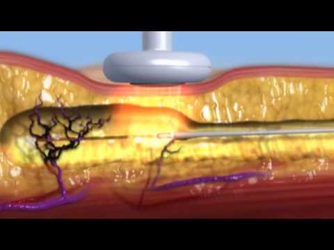 BodyTite by Invasix RFAL Animation - YouTube