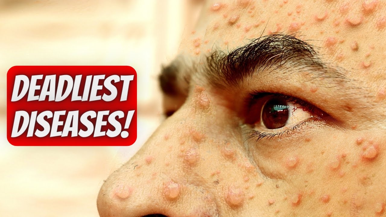Deadliest Diseases That Claim Millions of Lives Every Year - YouTube
