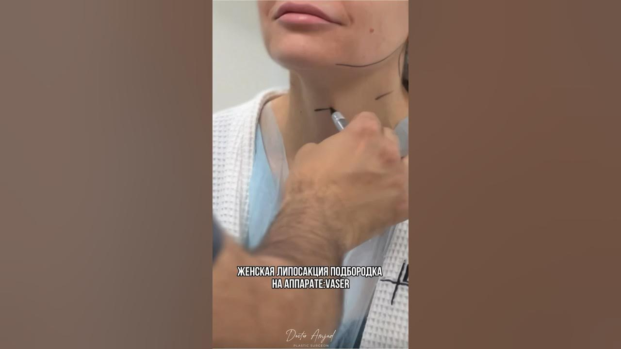 Женская липосакция подбородка на аппарате Vaser - YouTube