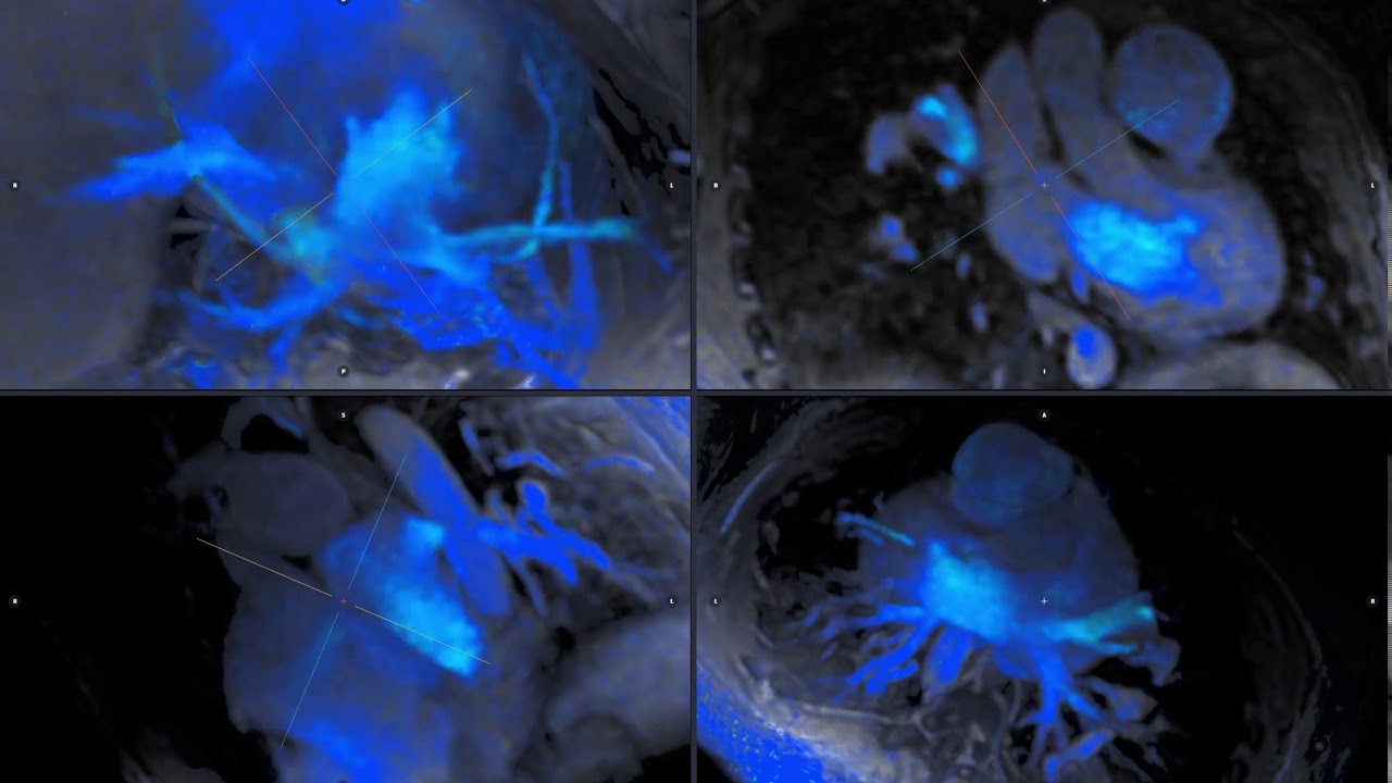 4D heart imaging - YouTube
