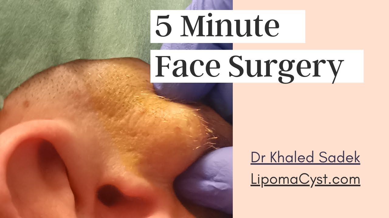 Large Face cyst comes out like butter! Dr Khaled Sadek. LipomaCyst.com ...