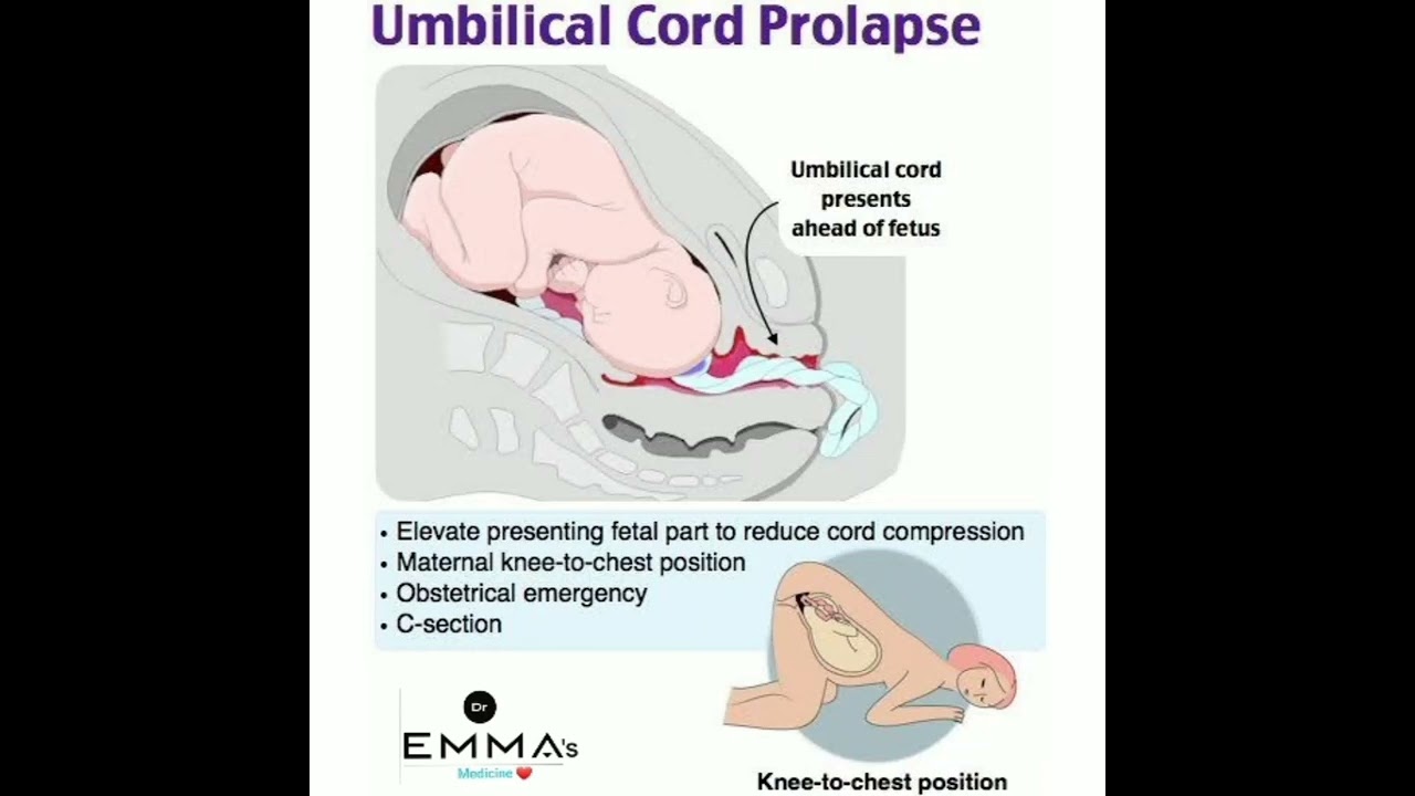 Knee Chest Position For Prolapsed Cord