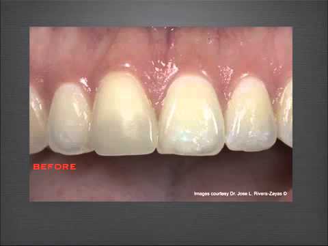 Prostodoncista-Dr. Jose L. Rivera Zayas 787-773-0123 - YouTube