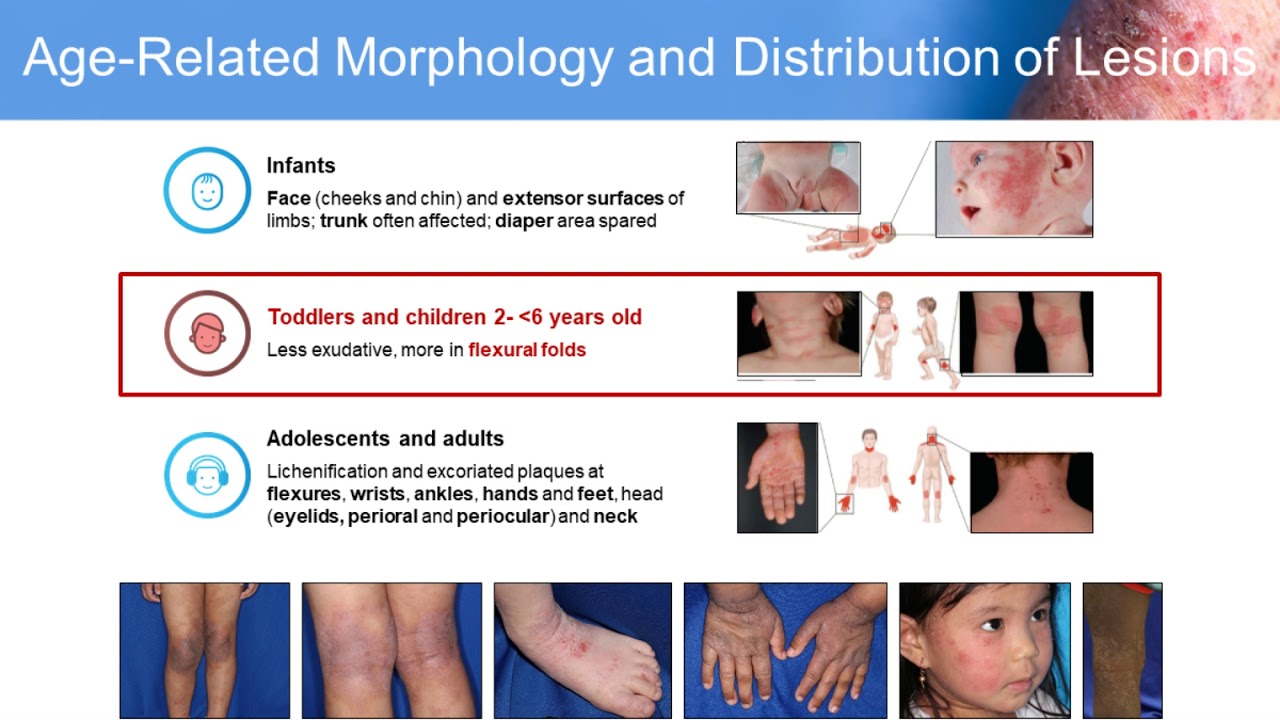 Atopic Dermatitis: Strategies to Improve Outcomes (Ages 2-5: Moderate ...