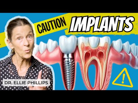 What Is Bad About Dental Implants