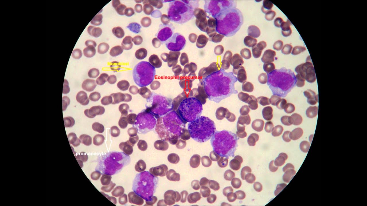 Acute Monoblastic Leukemia,M5b - YouTube