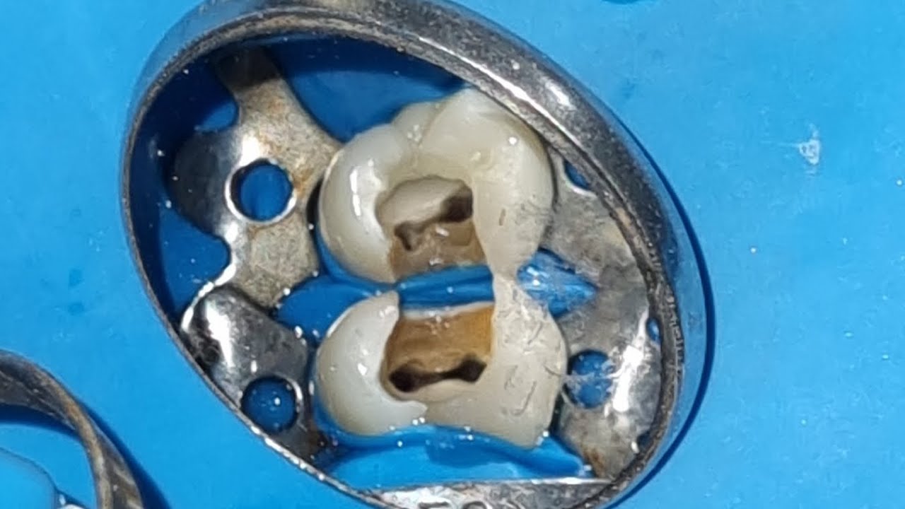 tratamento endodôntico (canal) - dentes 14 e 15 em sessão única - YouTube