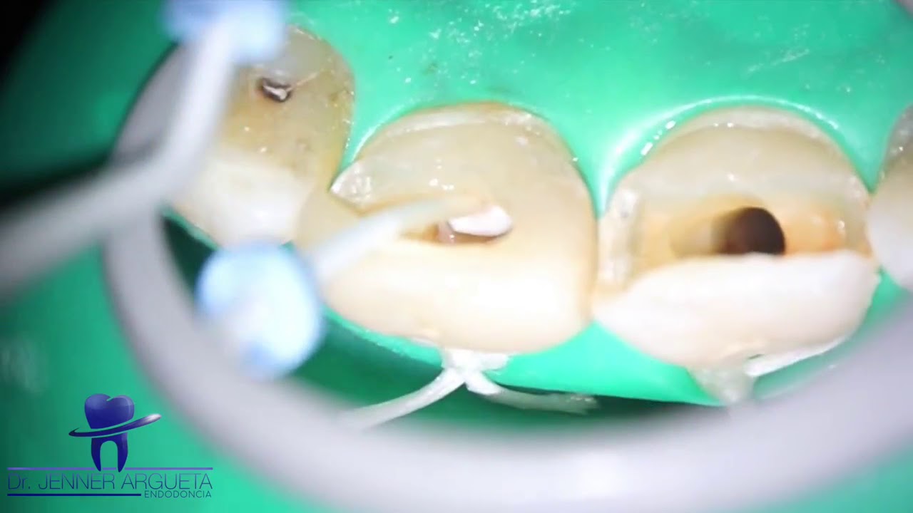 META BioMed Metapaste (75) - YouTube