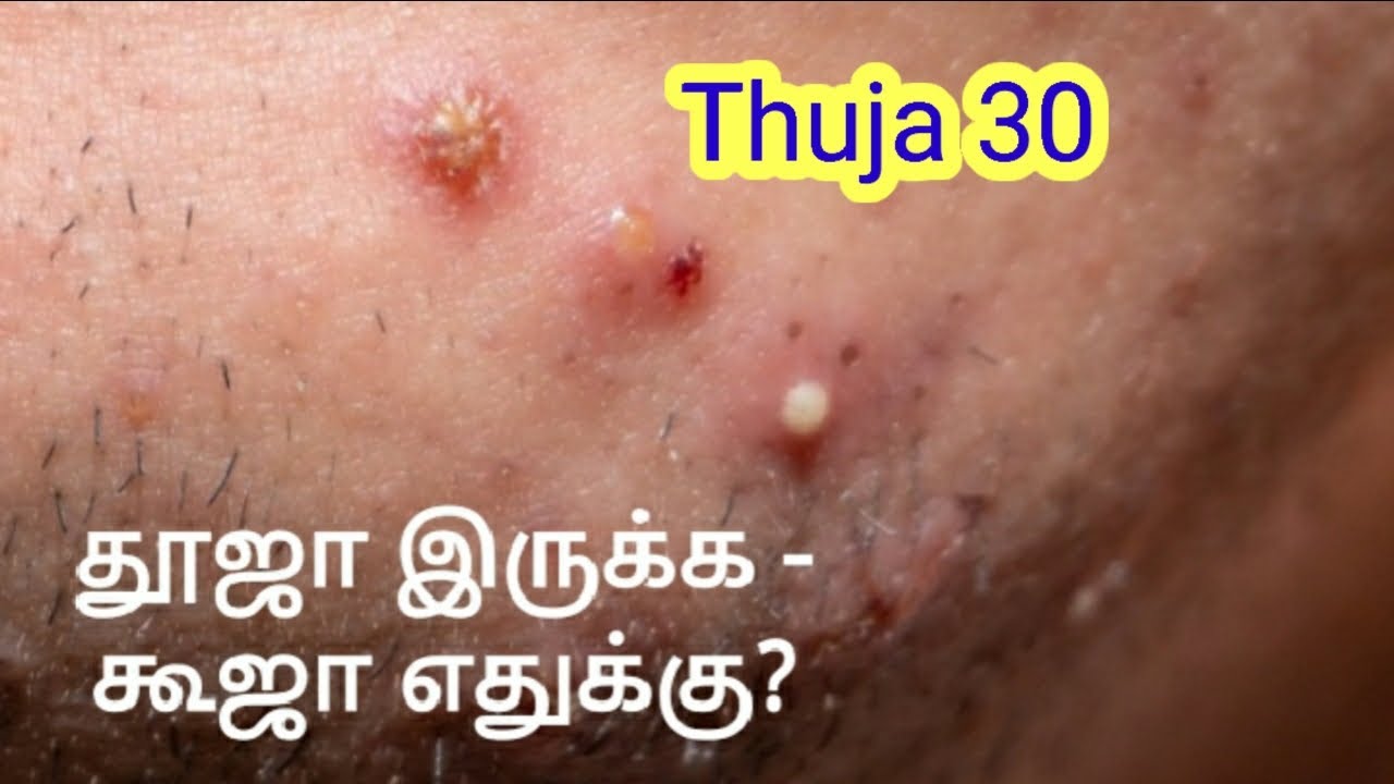 Thuja 30 | Pimples treatment | acne treatment | warts treatment | # ...