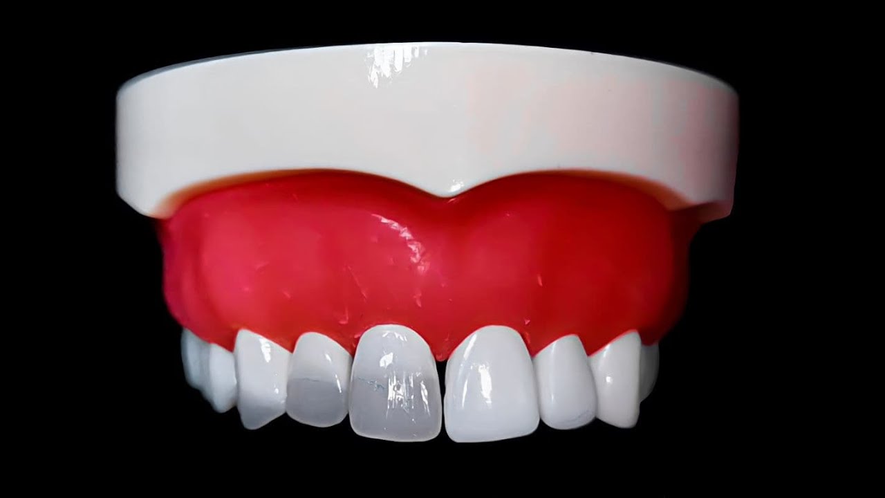 Class IV Composite Restoration - YouTube