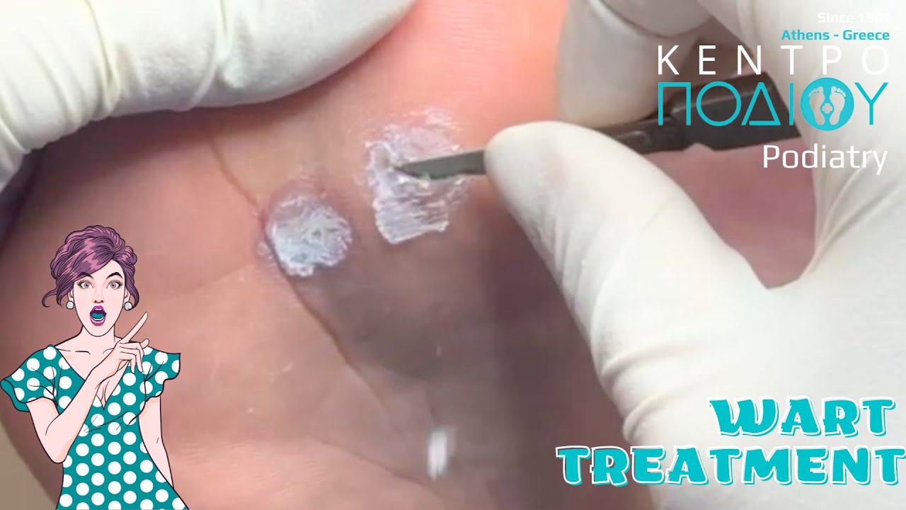 Wart treatment|Θεραπεία μυρμηγκιάς|Κέντρο Ποδιού Podiatry|Podiatrist ...