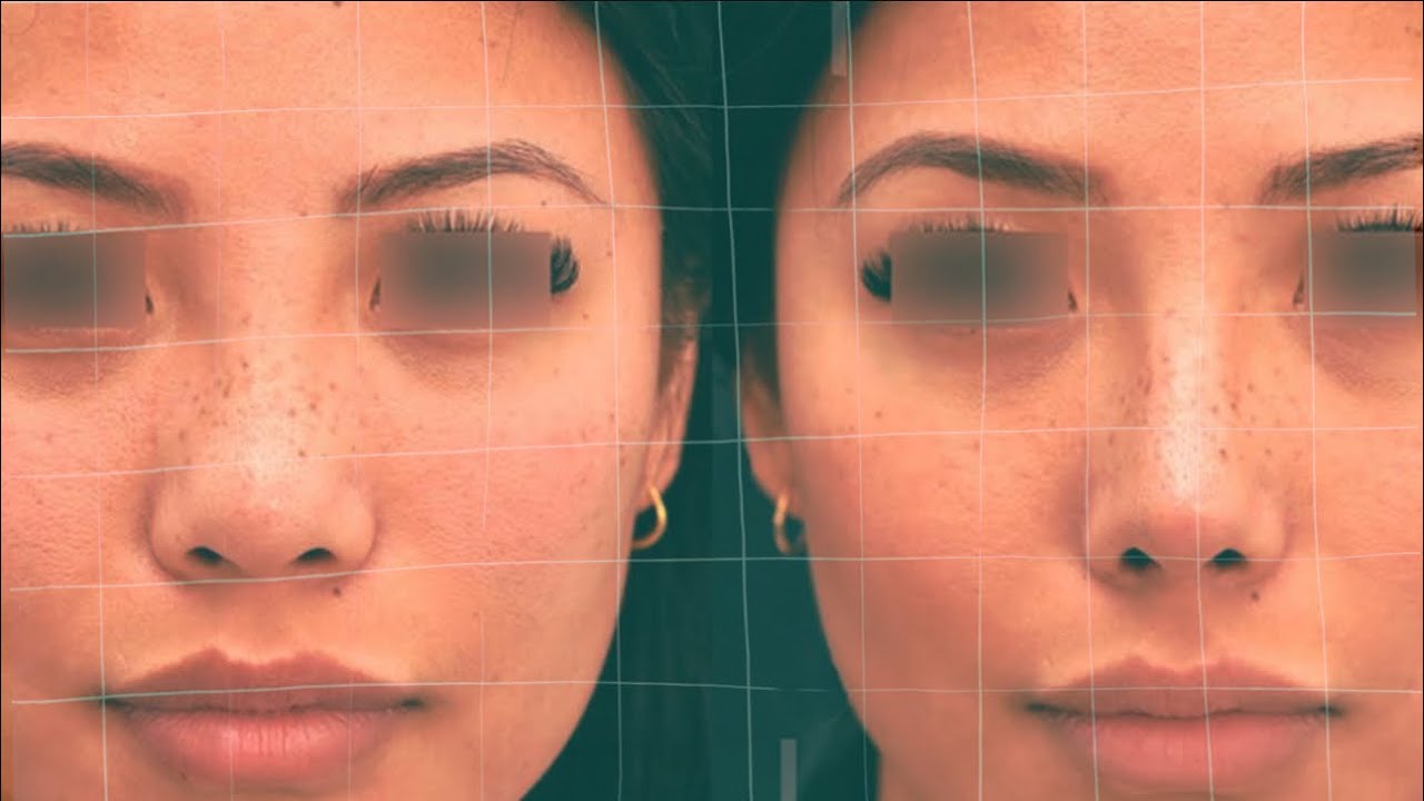Your Nose tip is so tiny and Your Alar base is so narrow ...