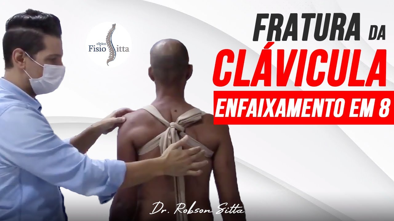 FRATURA CLAVÍCULA ENFAIXAMENTO em 8 POSTERIOR - Clínica de Fisioterapia ...