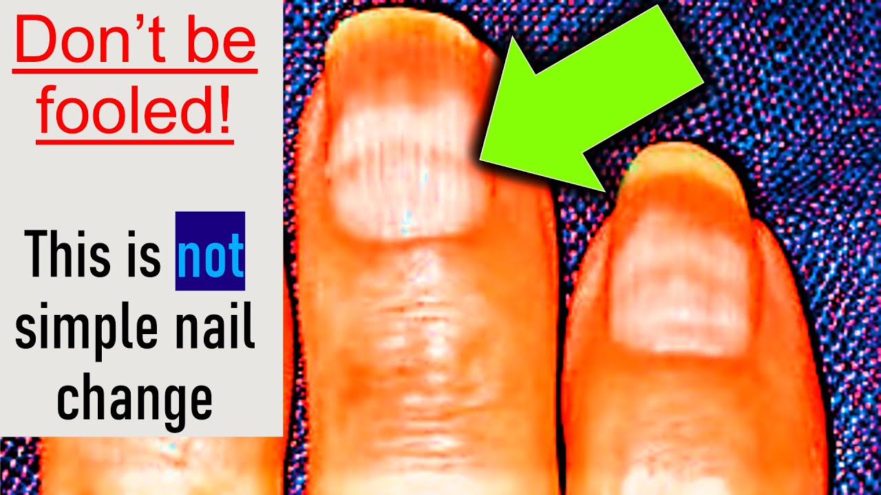 NAIL Color change You should never IGNORE! - YouTube