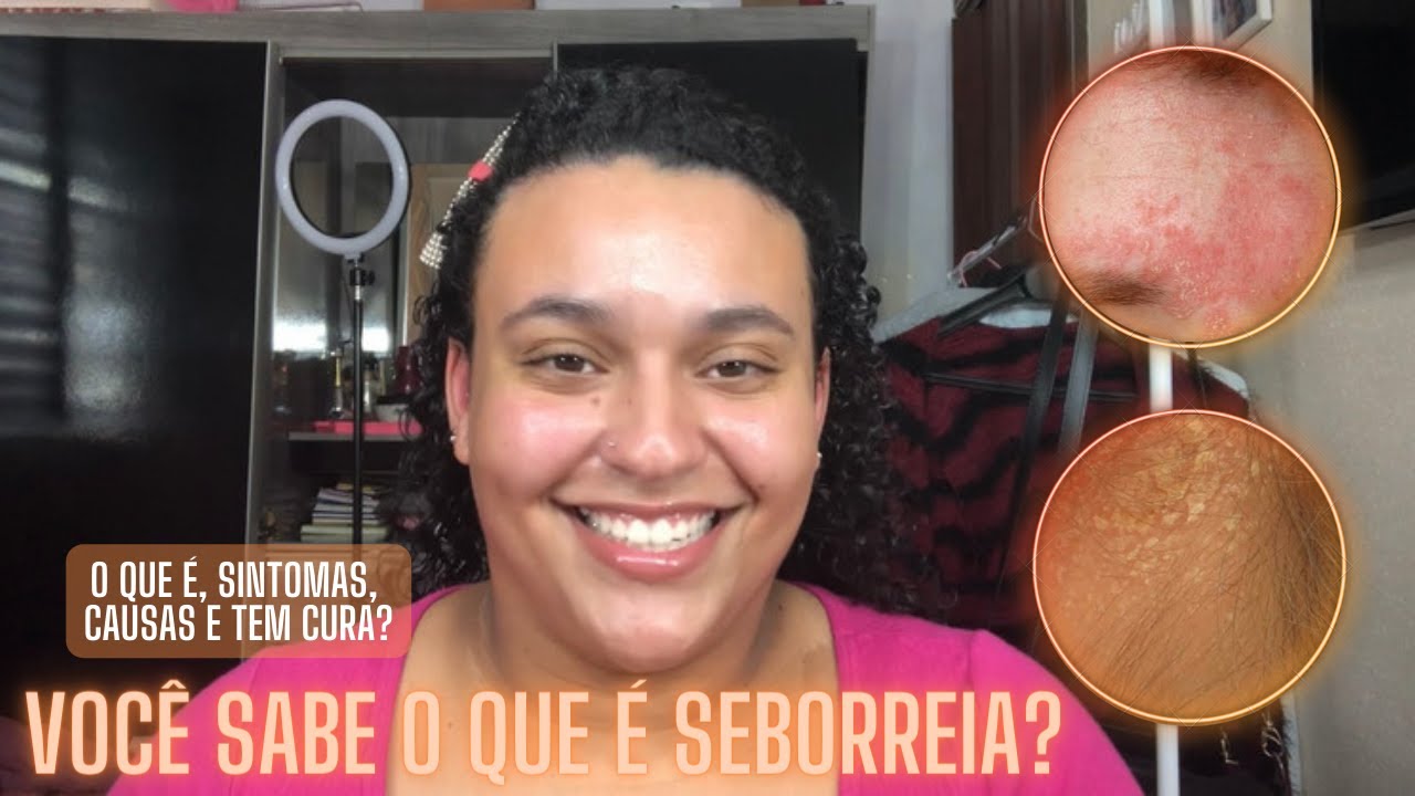 EXPLIQUEI TUDO SOBRE MINHA SEBORREIA *o que é, sintomas, causas e tem ...
