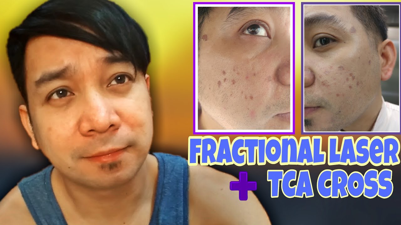 "FRACTIONAL LASER AT TCA" - Para Mawala ang BUTAS sa Mukha || Lessen ...