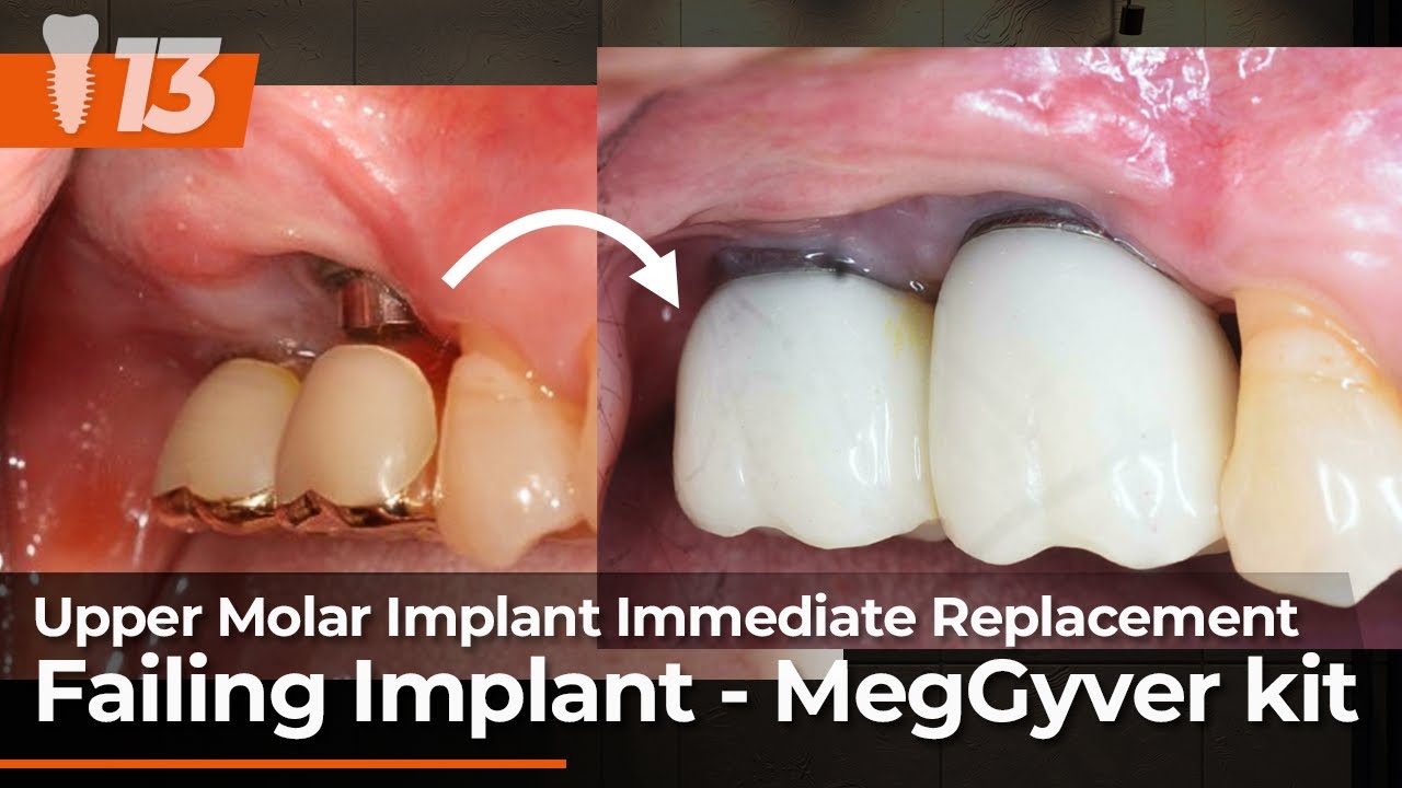 Upper Molar Implant Immediate Replacement Failing Implant - MegGyver ...