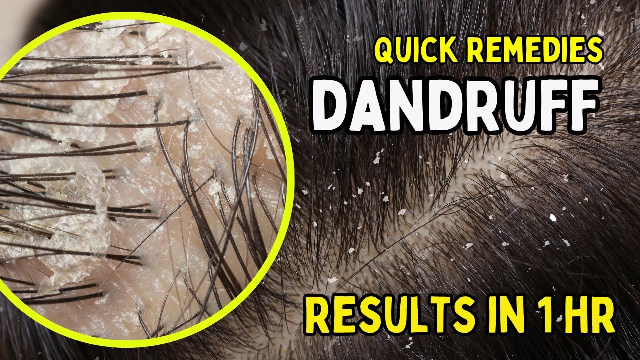 10 DIY Home Remedies for Dandruff - YouTube
