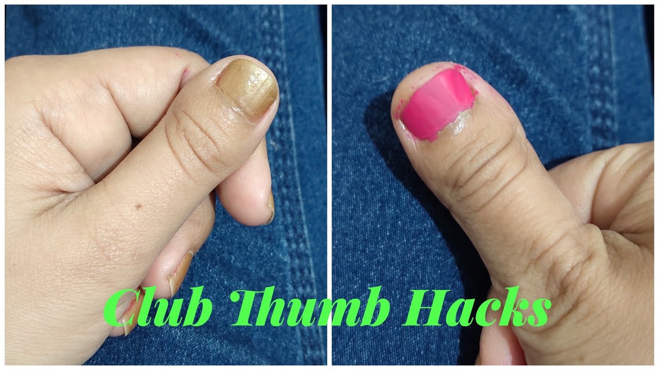 Hacks For Club Thumb || Wide Broad Thumb Tips - YouTube