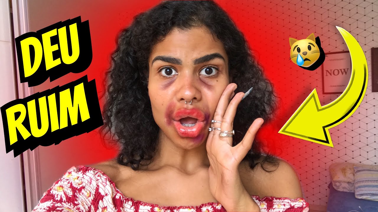 Fiz Preenchimento Labial E Deu Ruim Mostrei Tudo Youtube