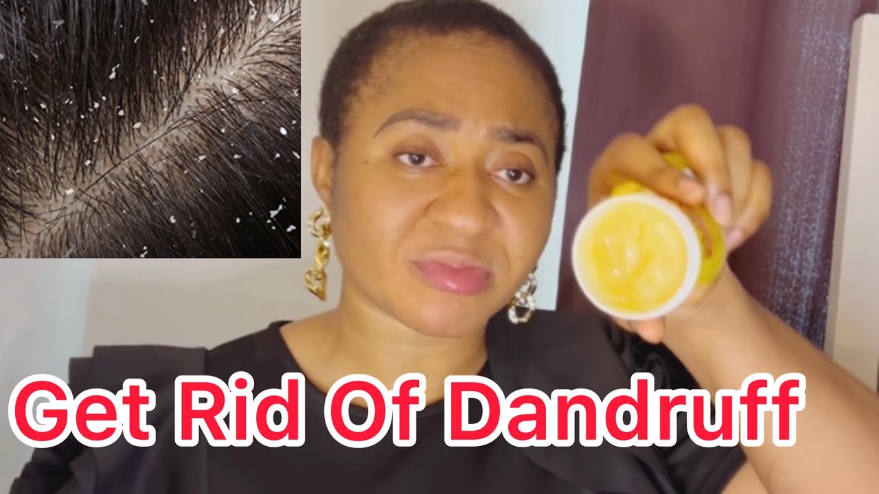 How To Get Rid of Dandruff Permanently | STOP Flaky Hair/Scalp ...