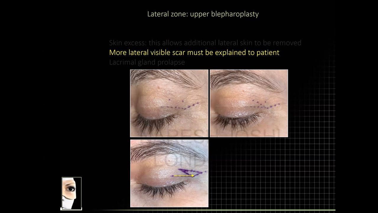 Upper Lid Blepharoplasty - Assessment and Execution - Mr Naresh Joshi ...