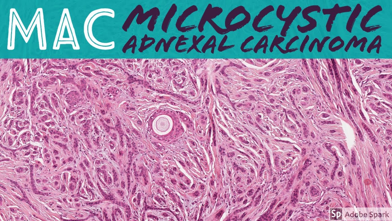 Microcystic Adnexal Carcinoma (MAC): 5-Minute Pathology Pearls - YouTube