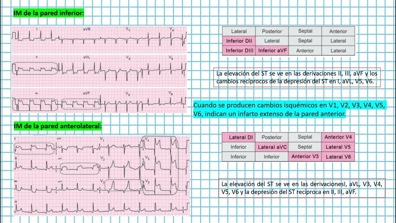 Ejemplos de INFARTO en el EKG ( Clases EKG #23) - YouTube