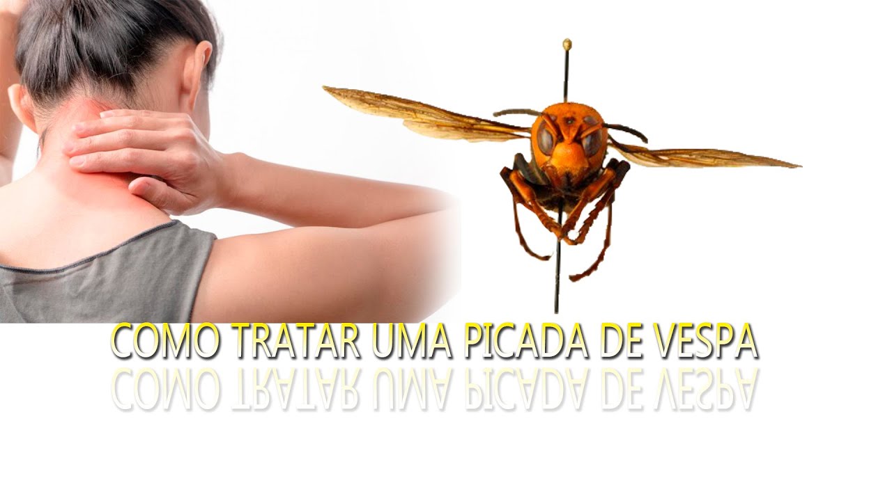 Como tratar a picada de vespa - YouTube
