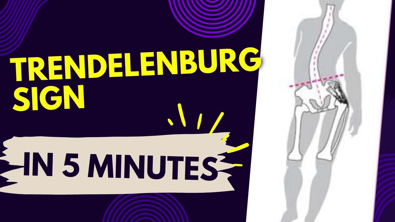 Trendelenburg sign - Abductor mechanism | In FIVE minutes - YouTube