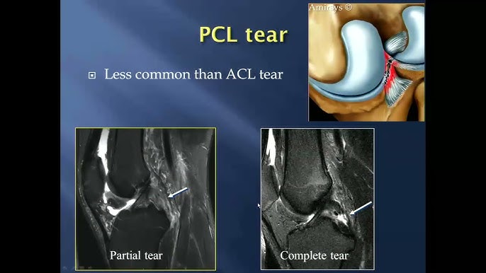 Mri Knee Acl Tear