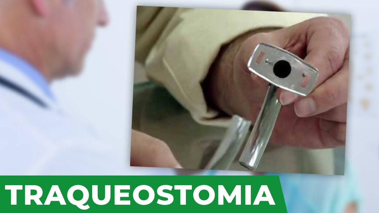 Traqueostomia no câncer de cabeça e pescoço - YouTube