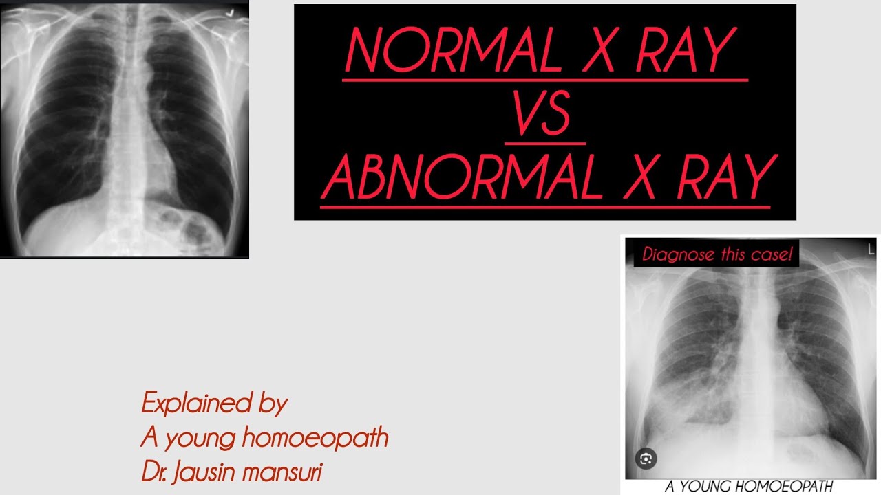 NORMAL CHEST X RAY Vs ABNORMAL CHEST X RAY PART 1 / A YOUNG HOMOEOPATH ...