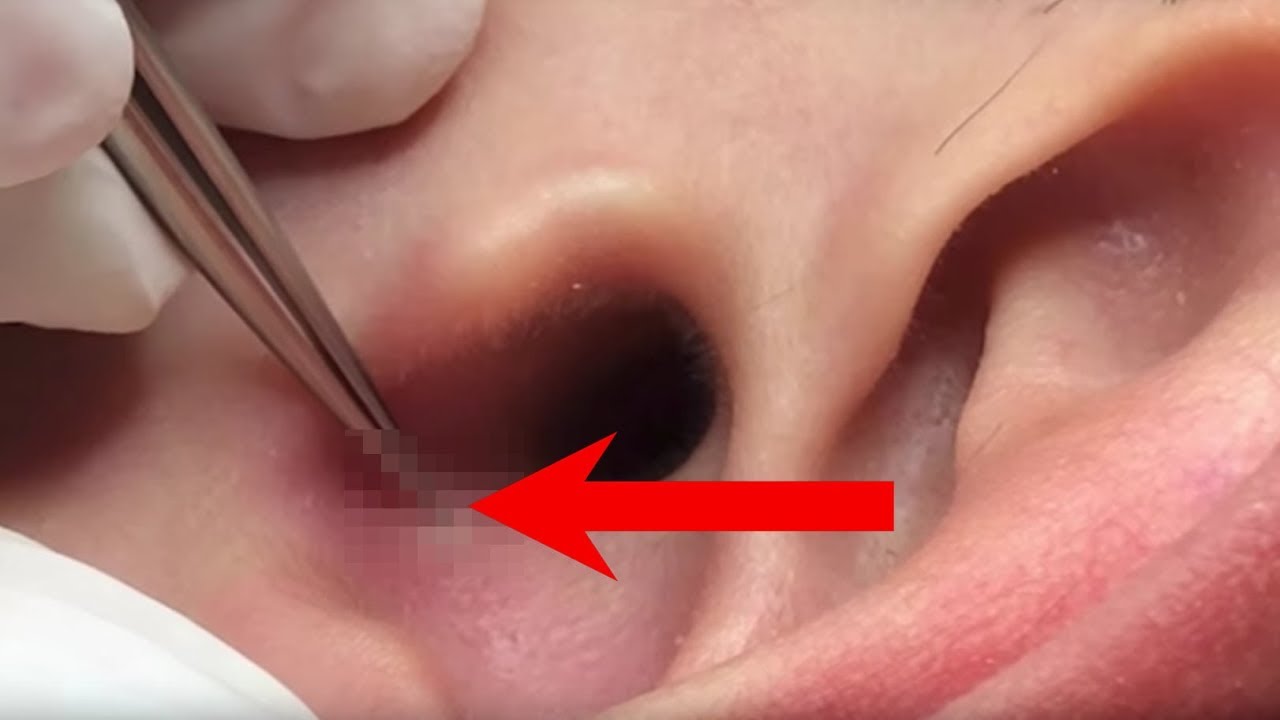Extraction Of A TINY Ear Blackhead SPA YouTube extraction-of-a-tiny-ear-blackhead-spa-youtube