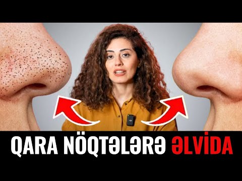Qara Nöqtə və Sızanaqlara ƏLVİDA! - Aptekə getməyə ehtiyac qalmadı