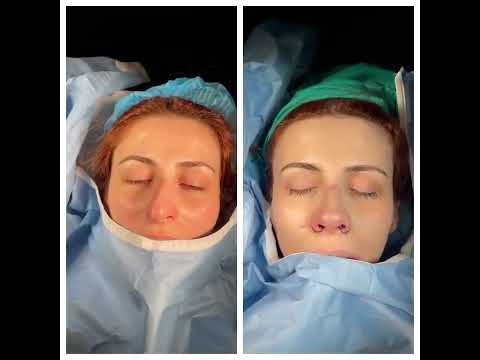 Burun estetiği ve burun deliği küçültme  #shorts #youtubeshorts #viral #viralvideo #trending #love