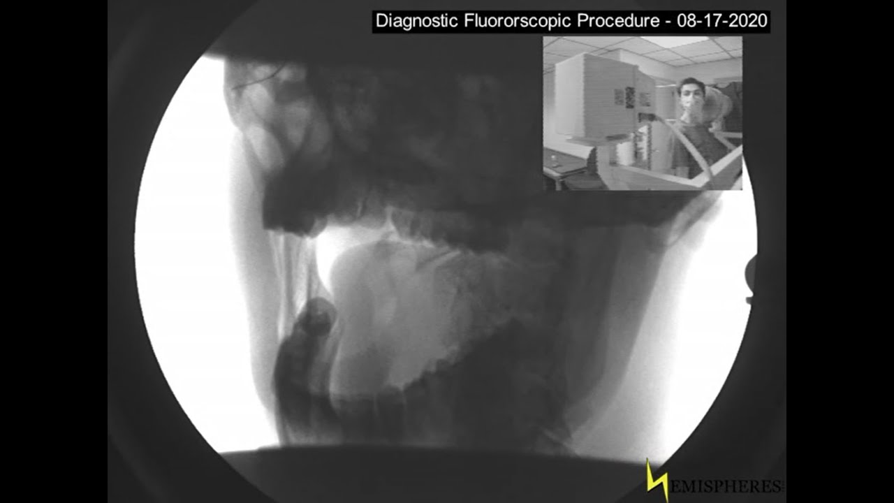 Josh's Neck Digital Motion X-Ray (DMX) 2 - YouTube
